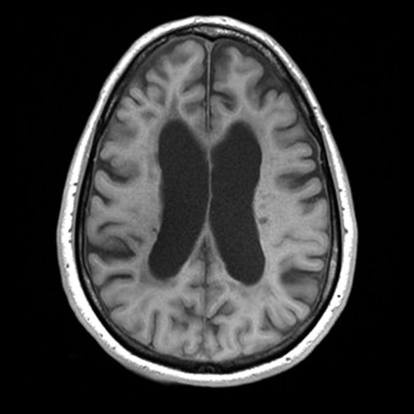 Esclerosis-Multiple-MSblog: Brain atrophy after CIS / Atrofia cerebral ...