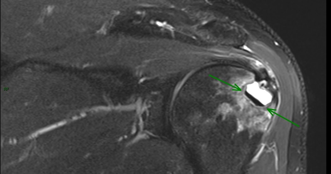 Hydroxyapatite crystal deposition disease (HADD): intraosseous ...