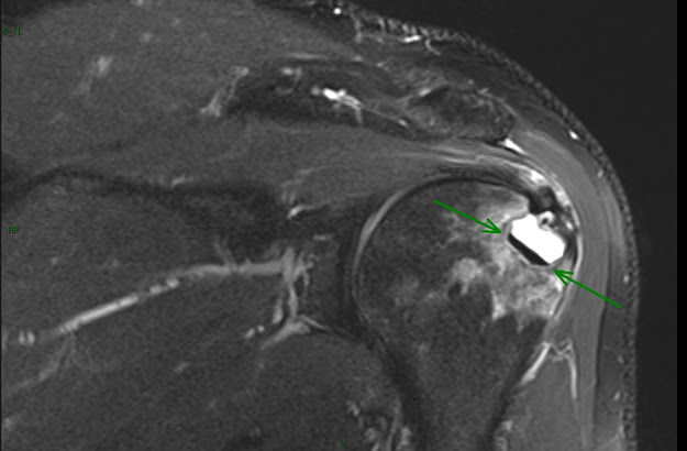 Hydroxyapatite crystal deposition disease (HADD): intraosseous ...
