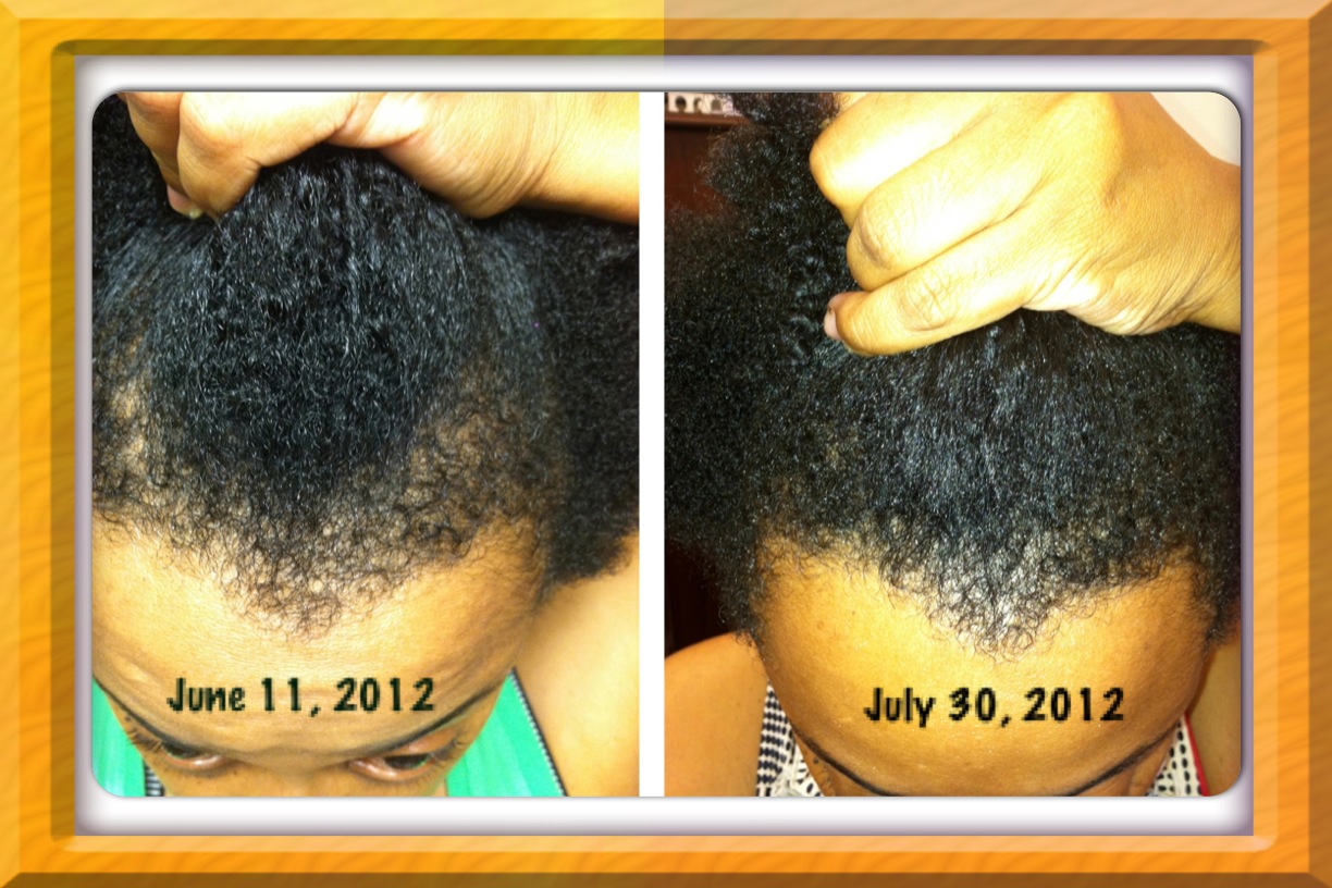 Flawed and Fabulous: Natural Hair Chronicles - Hair Loss Recovery