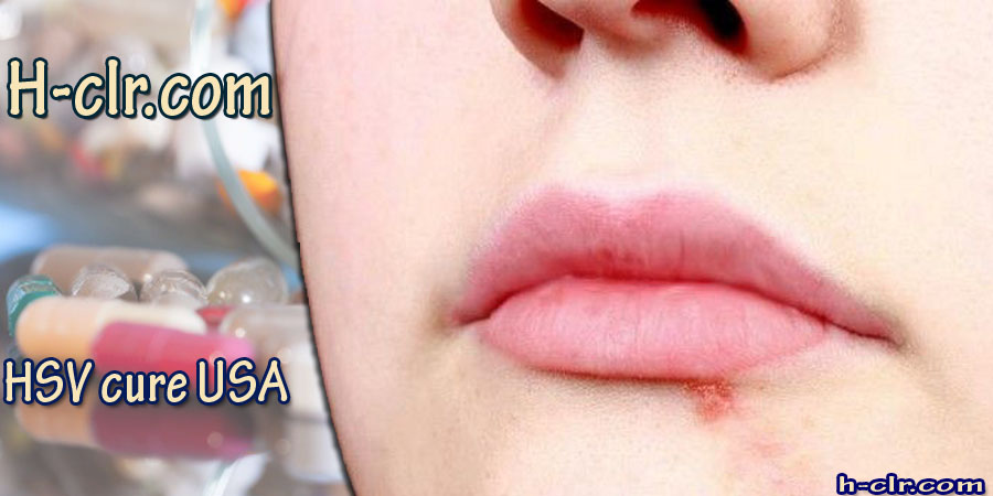 How effective is the natural HSV treatment?