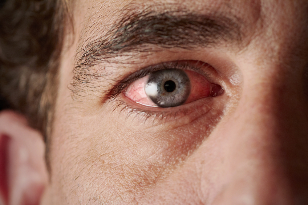 How to Care Your Eyesight: Different Symptoms of Red Eyes Disease