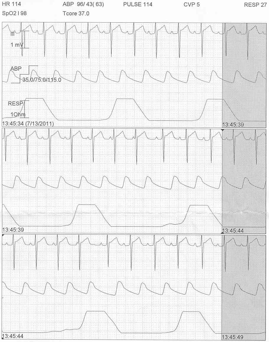 Pedi cardiology: EP - Isorhythmic Dissociation