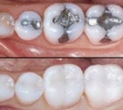 Smile To Work: Amalgam is fazing out