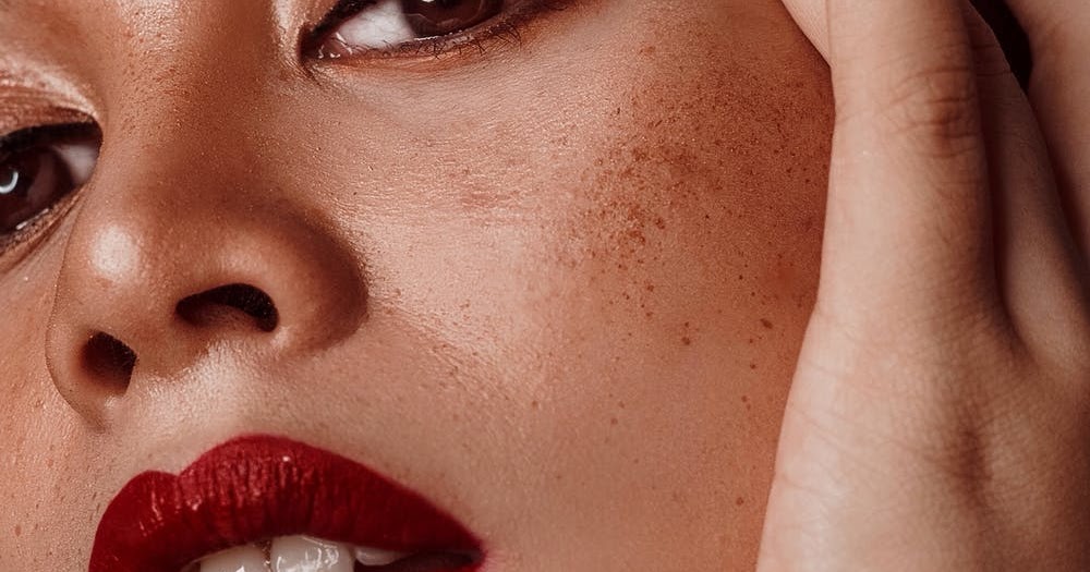 How to get rid of hyperpigmentation, freckles.