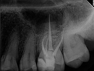 Bauman Endodontics: How many canals are normal?