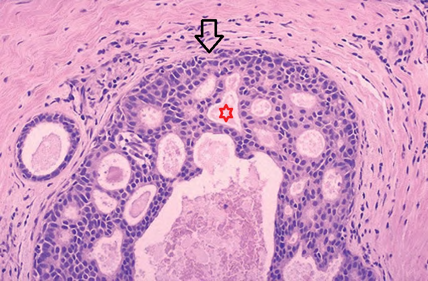 Histopatología: PATOLOGIA MAMARIA