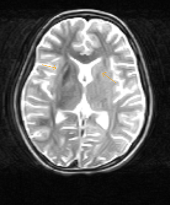 Basal Ganglia T1 Hyperintensity-MRI - Sumer's Radiology Blog