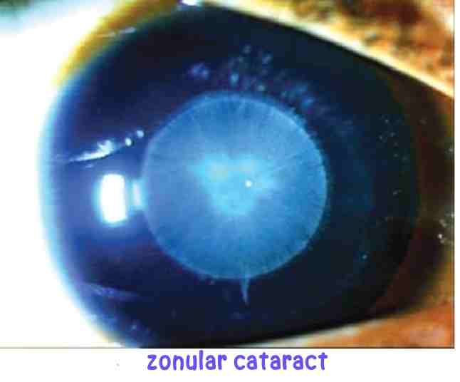 What is Cataract? causes, etiology pathophysiology