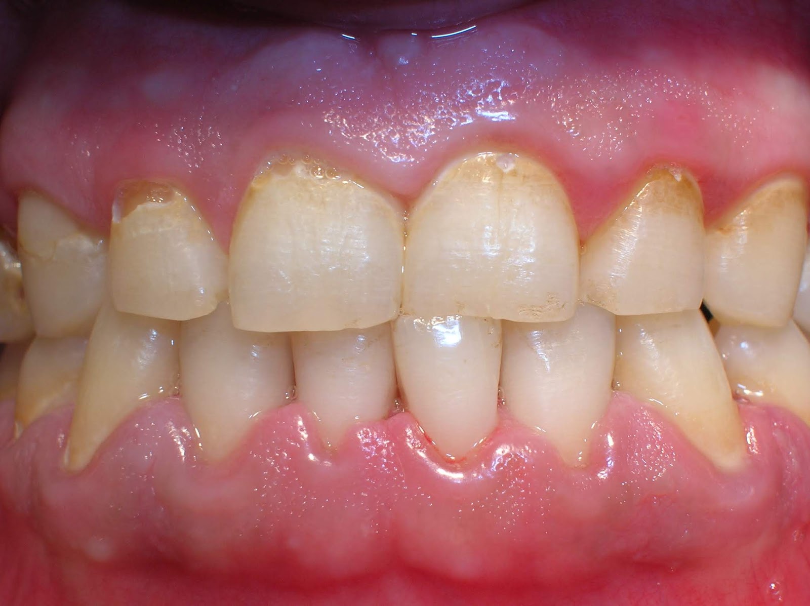 Mi Blog Bucodental: Cálculo Dental.