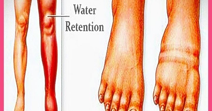 How to Get Rid of Water Retention and Lose Weight With 5 Simple Steps ...