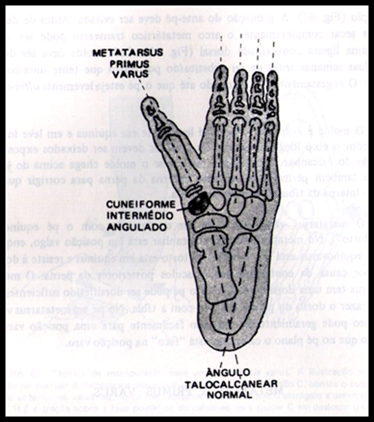 CARLOS GIDEÃO PODÓLOGO: JOANETES
