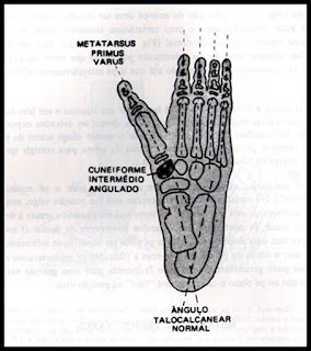 CARLOS GIDEÃO PODÓLOGO: JOANETES