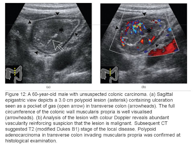 BÀI SOẠN VỀ SIÊU ÂM CHẨN ĐOÁN: COLONIC POLYPS: US DETECTION