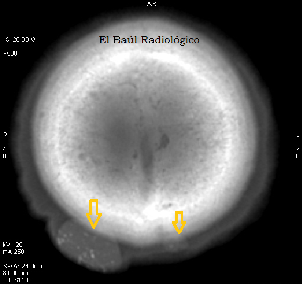 QUISTES SEBÁCEOS CALCIFICADOS DEL CUERO CABELLUDO (CALCIFIED SEBACEOUS ...