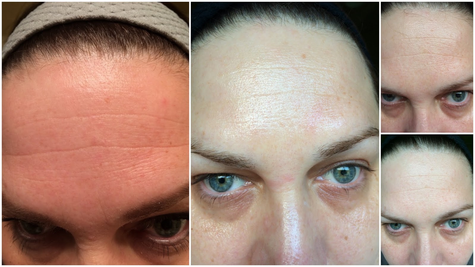 a Mom Looks at 40: Botox Check-in: Day 10
