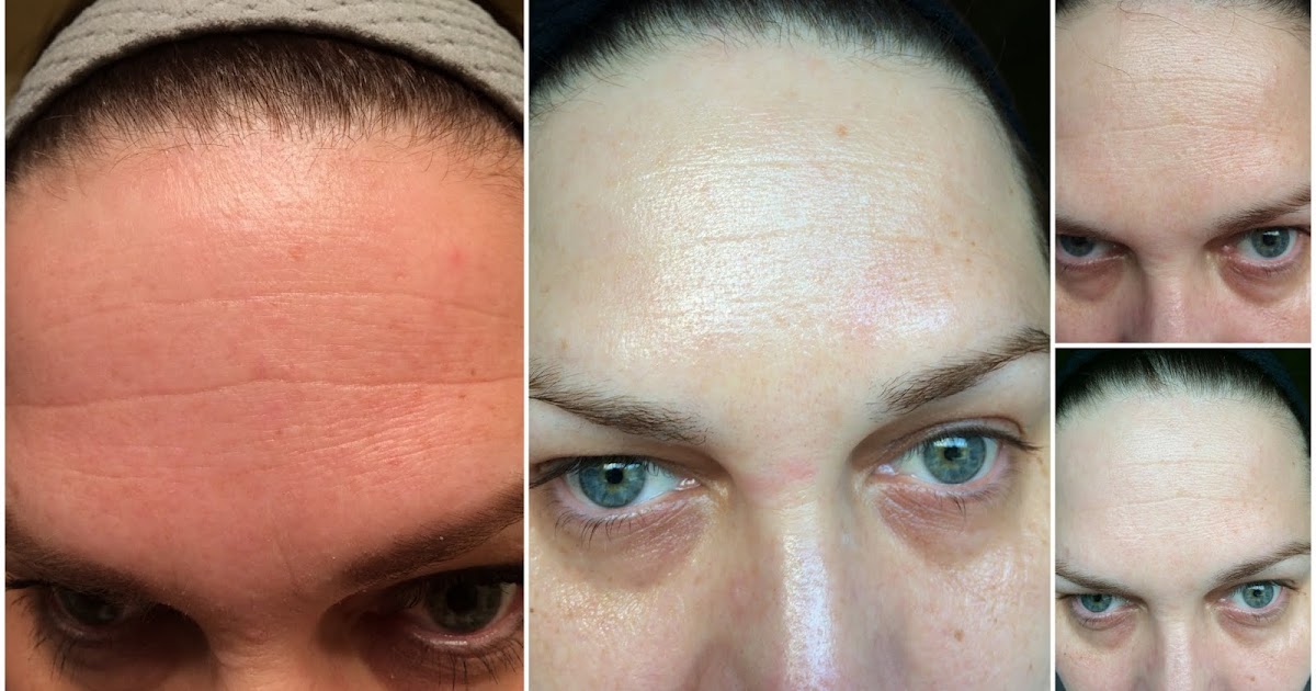 a Mom Looks at 40: Botox Check-in: Day 10