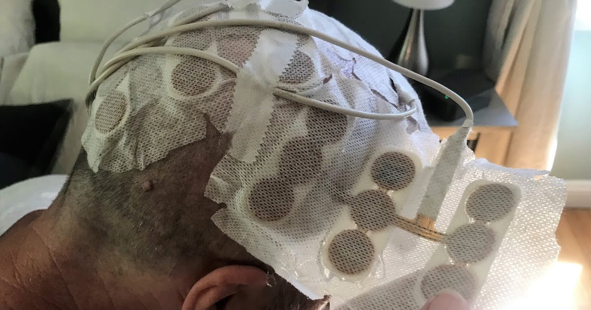 Brain cancer is...: Optune Wizardry