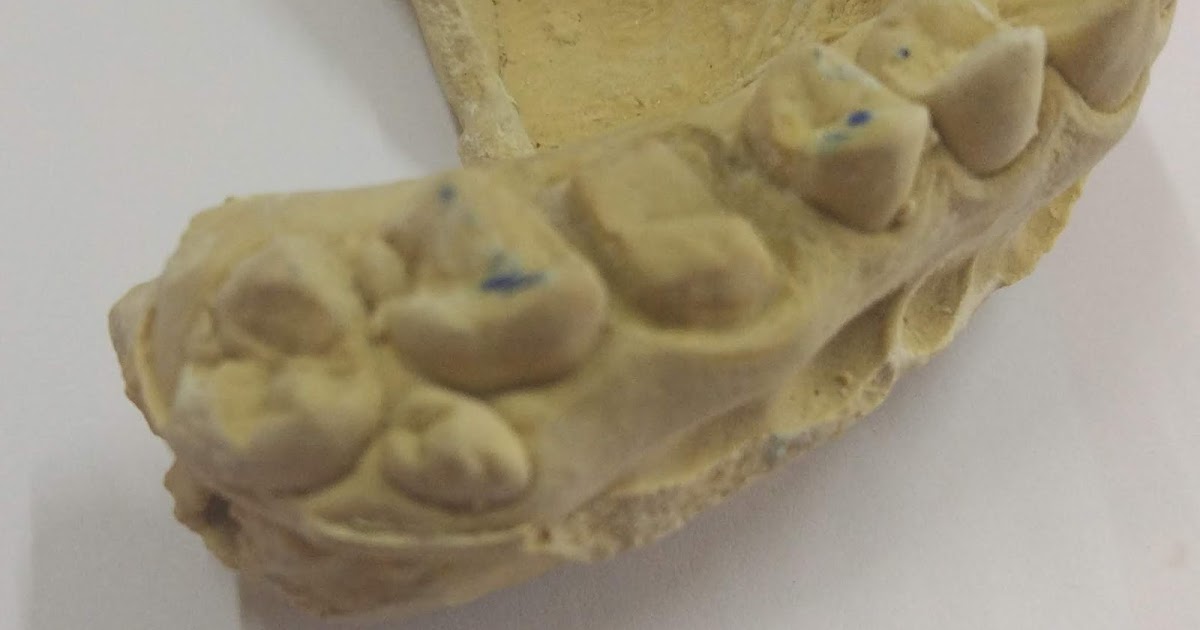 Oral Pathology India: ORAL PATHOLOGY- PARAMOLAR