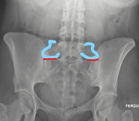 Bertolotti’s Syndrome | Growing Spine Blog | Washington University in ...