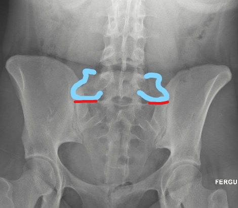 Bertolotti’s Syndrome | Growing Spine Blog | Washington University in ...