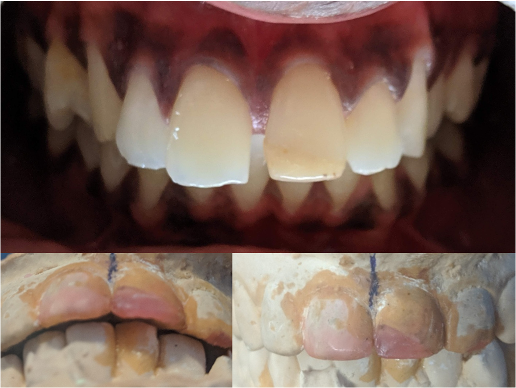 BIO-EMULATION with composite resin