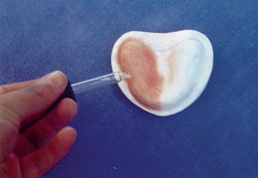 Prostodoncia total: Definición y conceptos de Prostodoncia Total