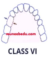 Kennedy's Classification_ Applegate's Rules || Prosthodontics RPD ...