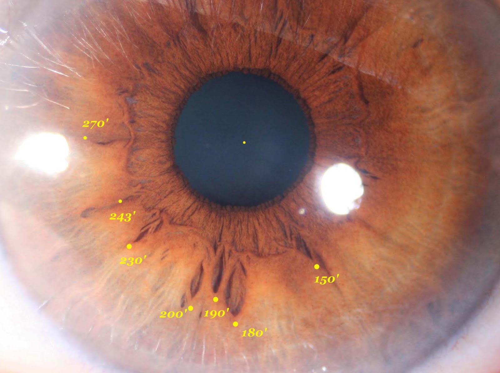 Modern & Multidimensional Iridology: Lacunae at External Border of the ...