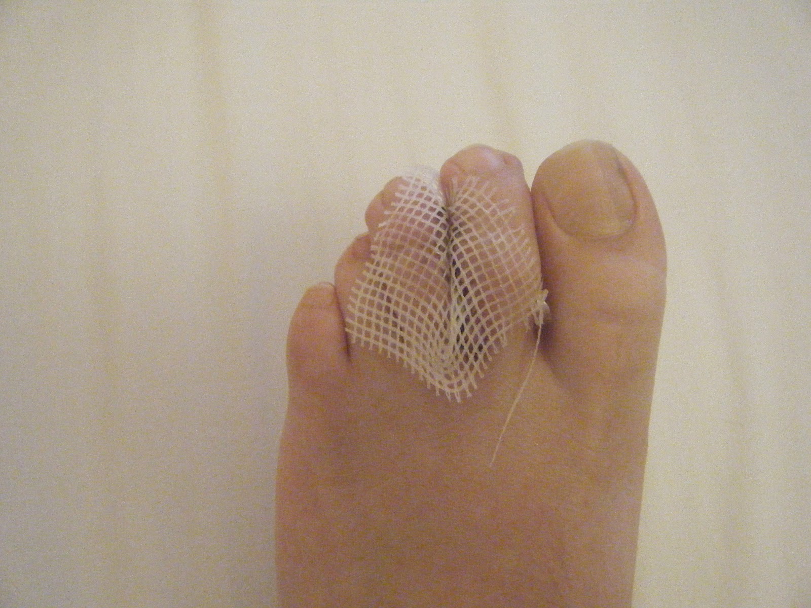 Syndactyly separation