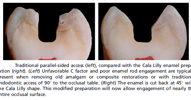 The Calla lilly prep in endodontics