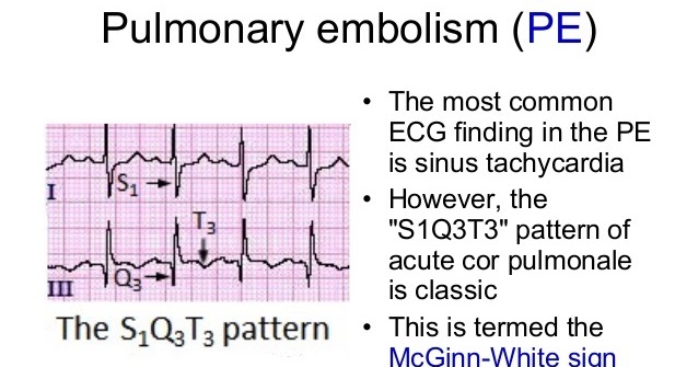 Prepare for Medical Exams : Regarding the most common ECG finding of ...