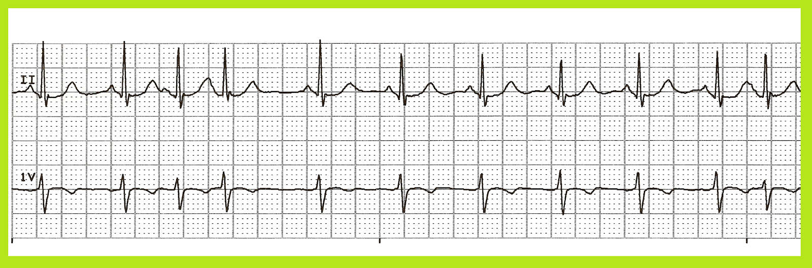 Various Rhythms with PACs