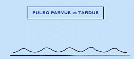 pulso parvus tardus cardiologia
