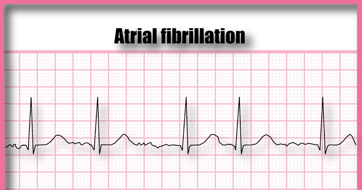 ECG Educator Blog : Atrial Fibrillation (AF)