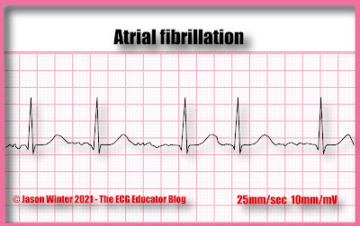 ECG Educator Blog : Atrial Fibrillation (AF)