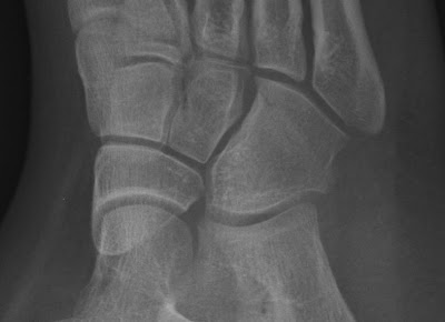 Daily Dose: cuboid fracture