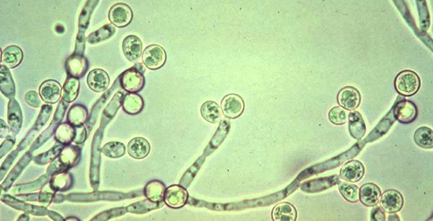 CANDIDIASIS