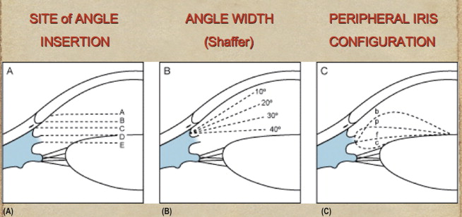 Ophthalmology Notes: Spaeth Gonioscopic Grading System (SGGS)