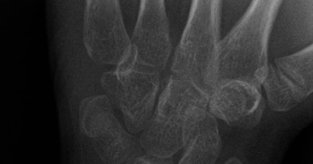 Buckle Bone Fracture Treatment | Symptoms | Surgery