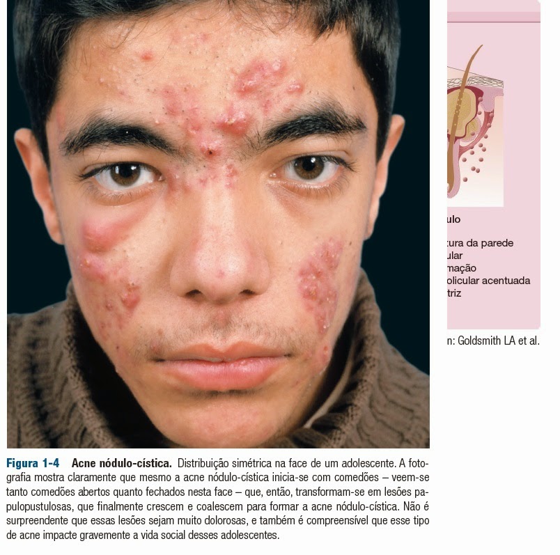 ENFERMAGEM: Acne vulgar (acne comum) e acne cística