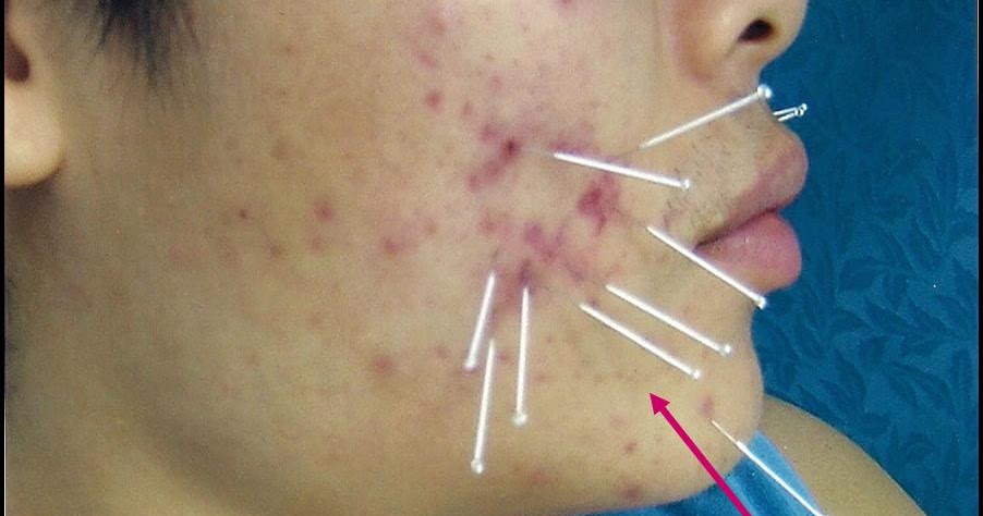 TCM News: Best TCM Doctor Treat Acne Pimples Rosacea TCM Clinic