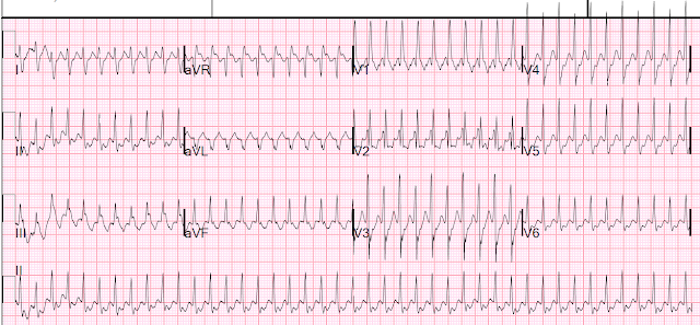 Dr. Smith's ECG Blog: Young Man with a Heart Rate of 257. What is it ...