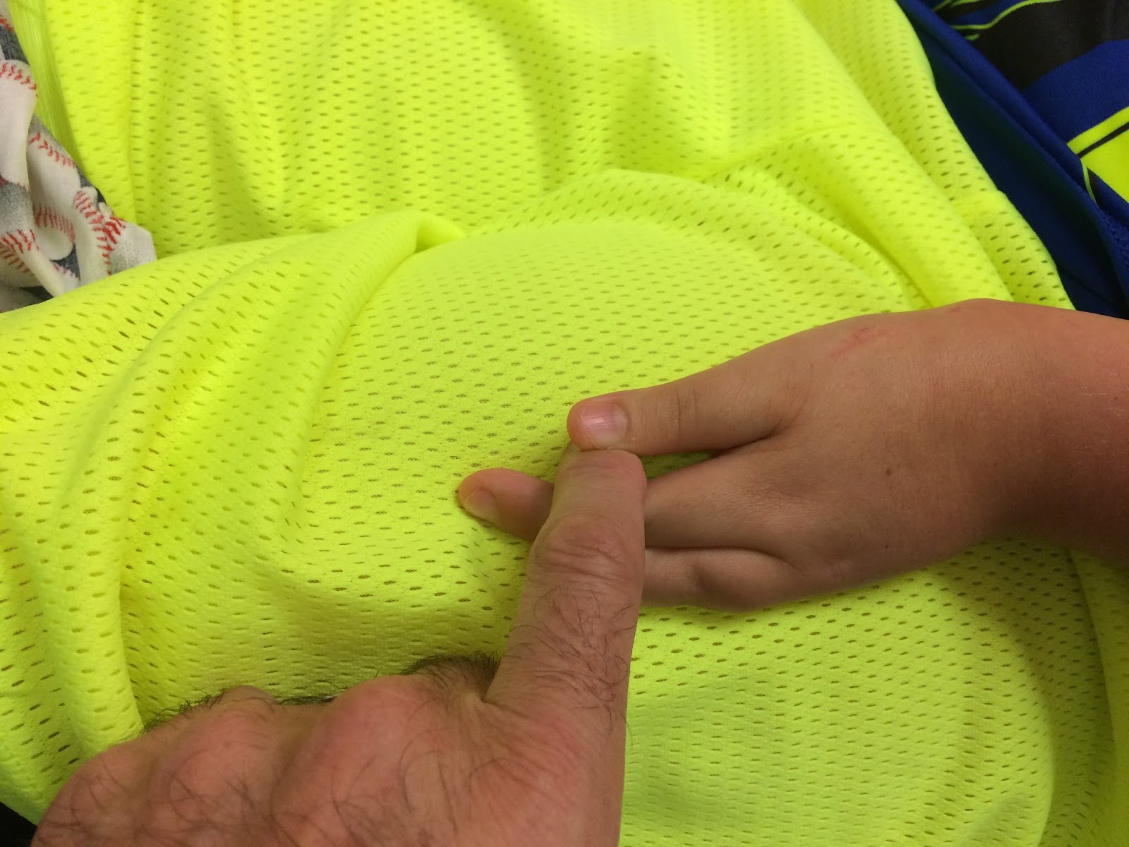 Thumb position and the 3 digit hand | Congenital Hand and Arm ...