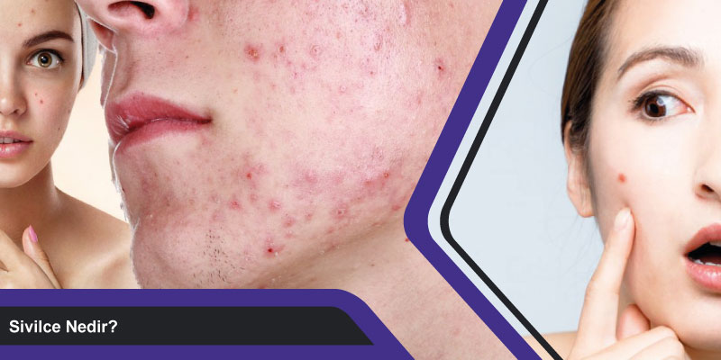 Didemin Kozmetik Dünyası: Sivilce Nedir
