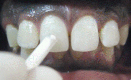 Pulp Vitality Tests with Classification and Recent Advances