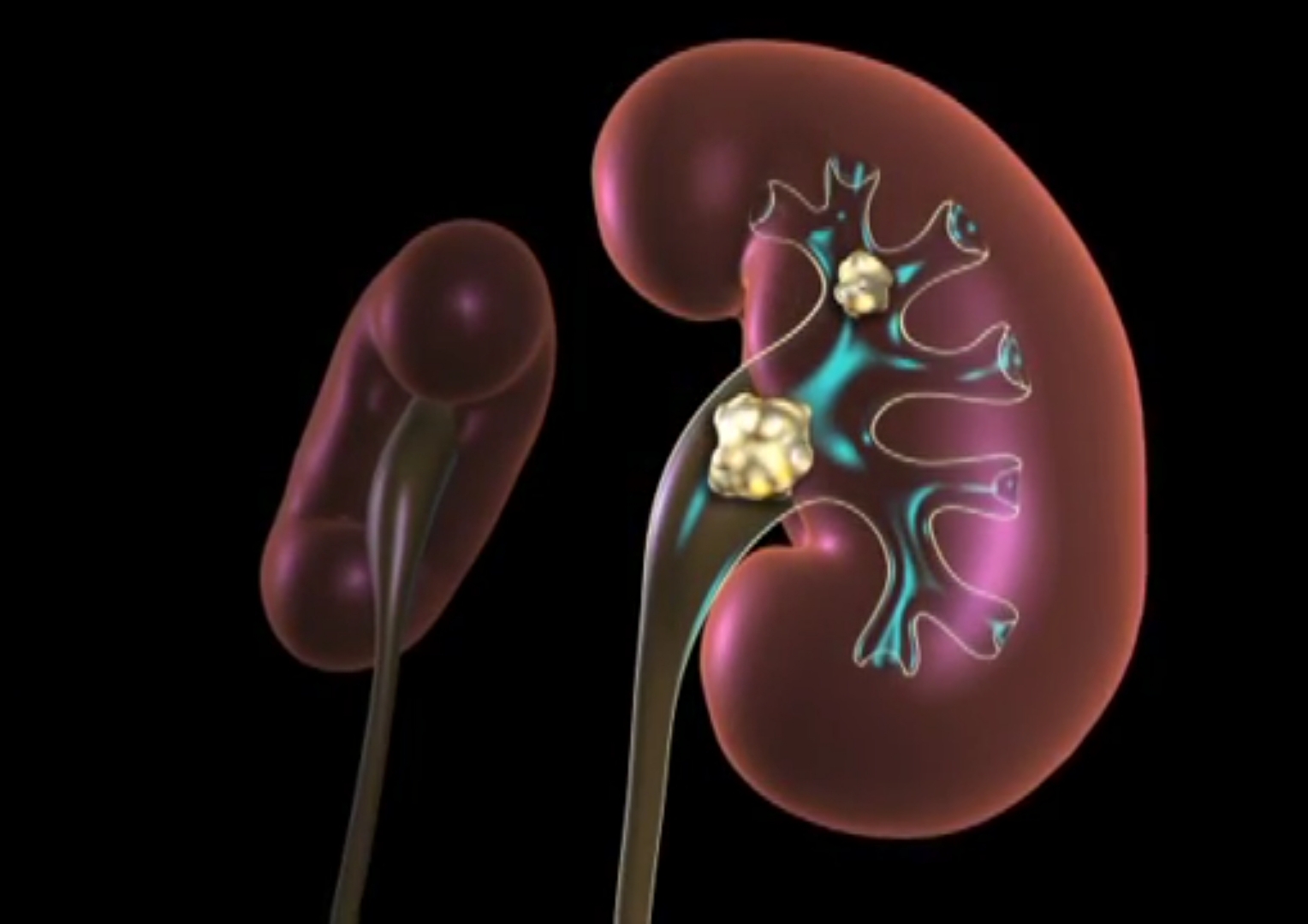 Ureteroscopy (URS) kidney stone