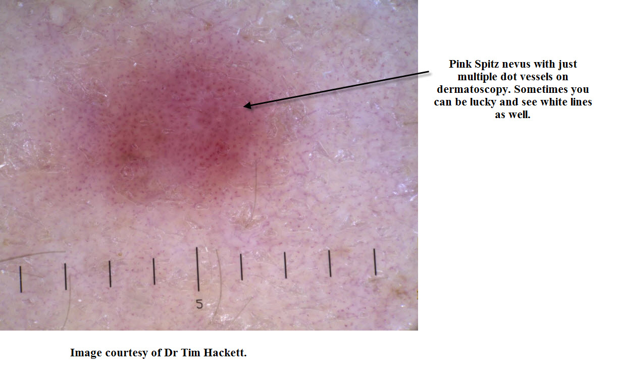 Dermpath Made Simple - Neoplastic: Spitz Nevus and Reed Nevus