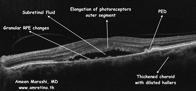 Chronic Central Serous Chorioretinopathy fundus image, OCT and FFA in a ...