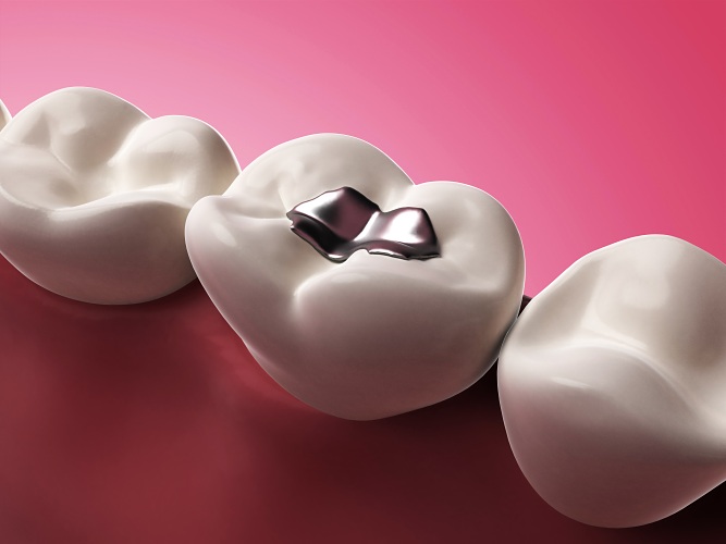CLINICA MIMA: AMALGAMA DENTAL